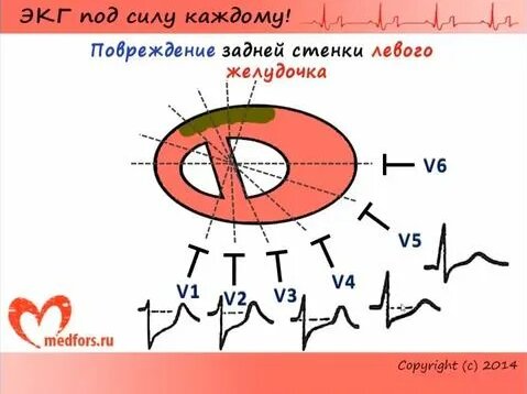 Урок 10. Видеокурс ЭКГ под силу каждому. - Смотреть онлайн в поиске ...