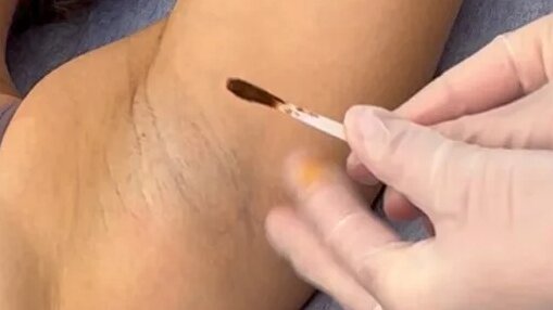 Лечение гипергидроза Быстро и эффективно гипергидроз косметологспб Смотреть онлайн в