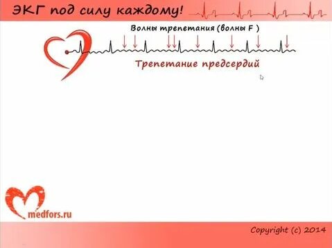 Урок 5. Видеокурс ЭКГ под силу каждому. - Смотреть онлайн в поиске ...