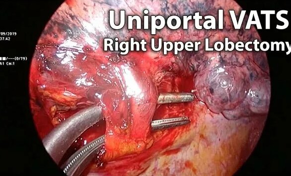 Uniportal VATS Sağ Üst Lobektomi - Смотреть онлайн в поиске Яндекса по Видео
