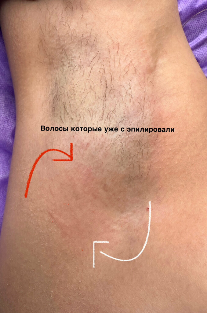 Epilasyon Epil_bees, Moskova, foto