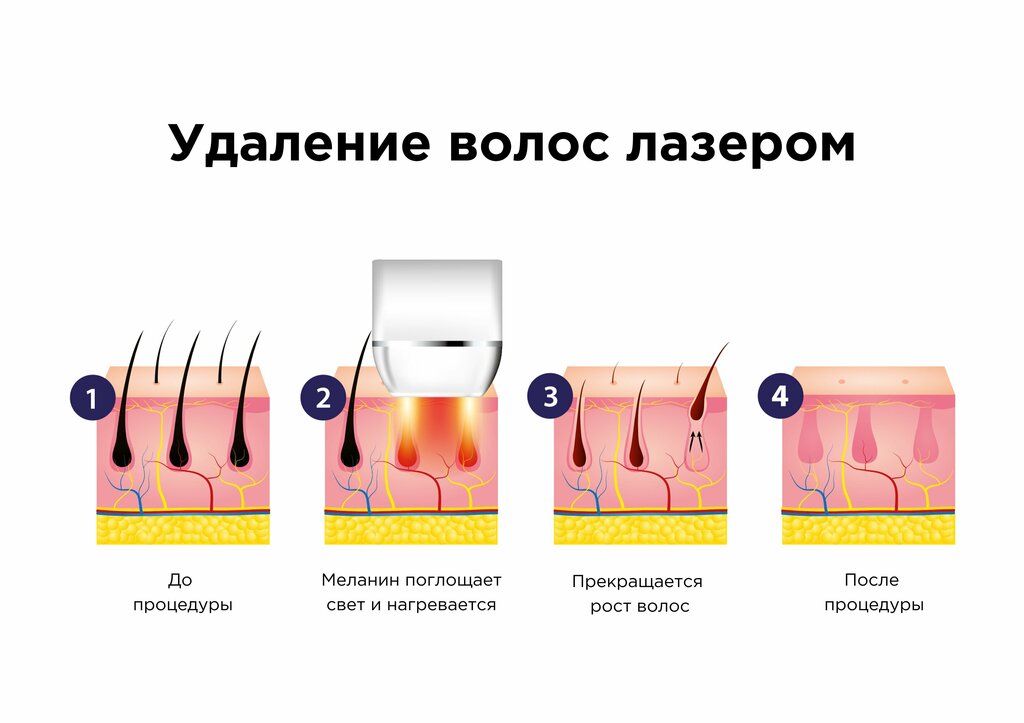 Epilasyon ЭпилШик, Stavropolski krayı, foto
