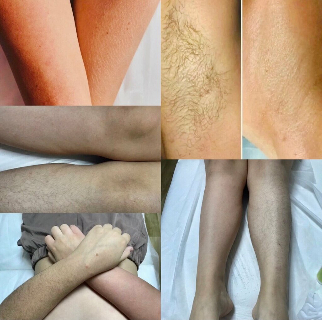 Epilasyon Blackberry, Krasnodar, foto