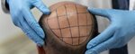 Continental Hair Transplant Istanbul (İstanbul, Şişli, Harbiye Mah., Maçka Cad., 18B), tıp merkezleri ve klinikler  İstanbul'dan