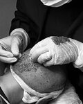 Este In Turkey Hair Transplant - Plastic Surgery (İstanbul, Ataşehir, Vedat Günyol Cad., 22A), plastik cerrahi klinikleri  İstanbul'dan