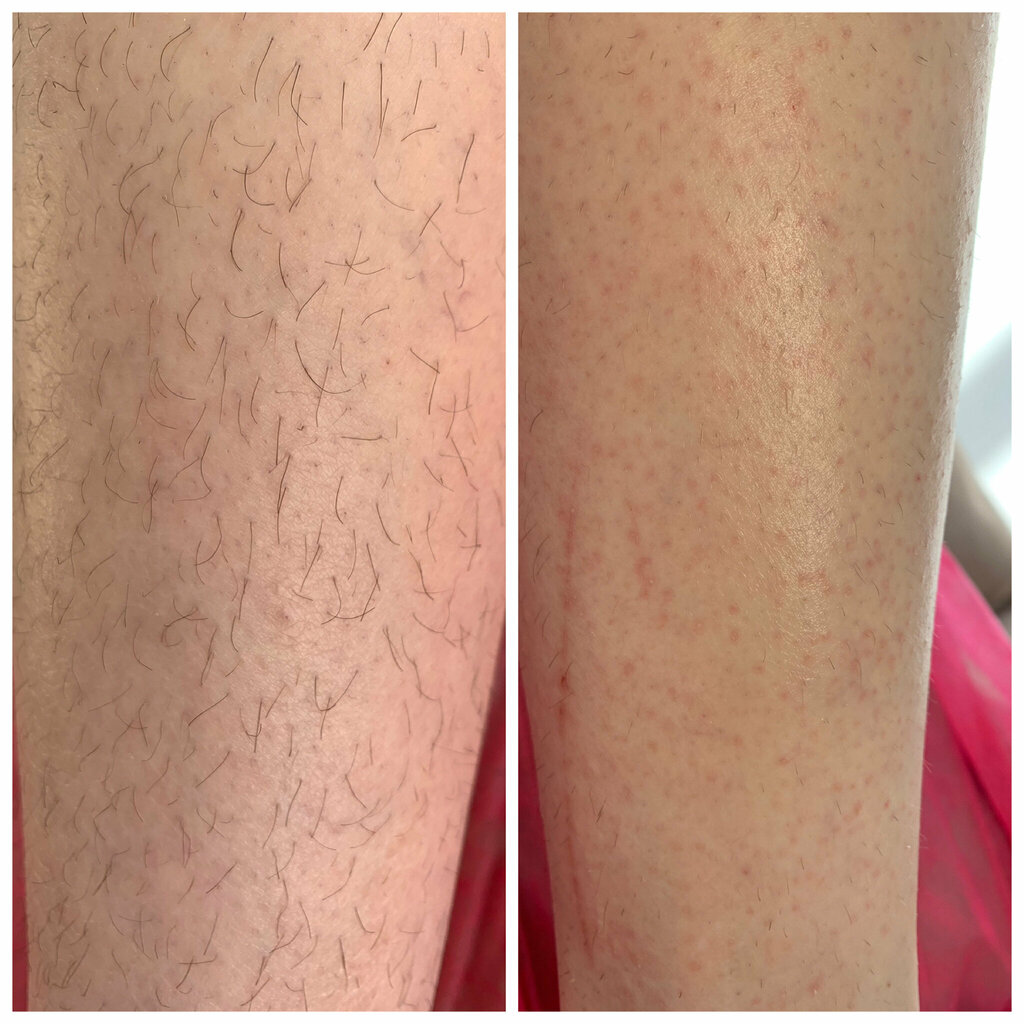 Epilasyon Bikini by Nina, Kazan, foto