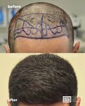 Sade Hair Transplant (İzmir, Çiğli, Ataşehir Mah., 8229. Sok., 3B), tıp merkezleri ve klinikler  İzmir'den