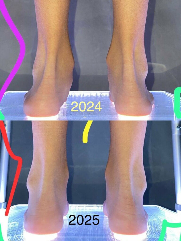 Protez yapımı Customized Ortho Insoles, Kazan, foto