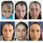 Dr. Metin Temel Plastik Rekonstrüktif ve Estetik Cerrahi (Yenişehir Mahallesi, Ankara Caddesi No:403 Pendik, İstanbul), plastik cerrahi klinikleri  İstanbul'dan