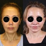 Op. Dr. Barış Keklik Turkey Breast Augmentation Rhinoplasty Thread Lift Facelift Cat Eye (İstanbul, Üsküdar, Acıbadem Mah., Çeçen Sok., 25/B2), özel muayenehaneler  İstanbul'dan