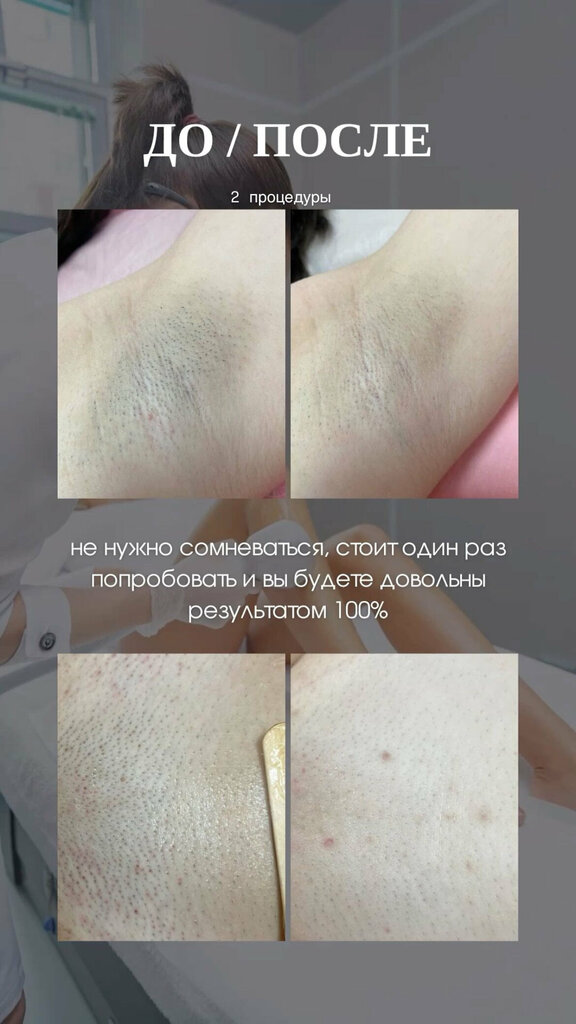 Epilasyon Nektarin epil, Moskova, foto