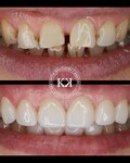 Diş Hekimi Kerem Karaçor Smile Design Laminate Veneer Emax Gülüş Tasarımı Implant Dentist Kerem Karacor (Muğla, Marmaris, Yunus Nadi Cad., 29/1), özel ağız ve diş sağlığı klinikleri ve muayenehaneleri  Marmaris'ten