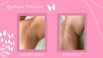Electroepilation (Ozerkovskaya Embankment No:50с1), epilasyon  Moskova'dan