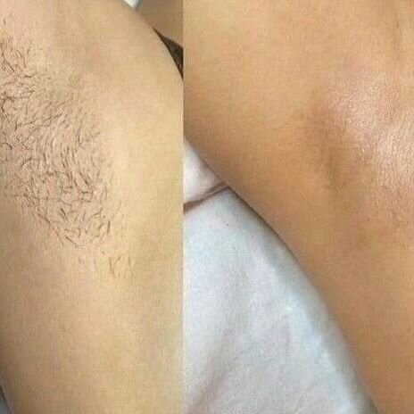 Epilasyon Silk_glow, Moskova, foto