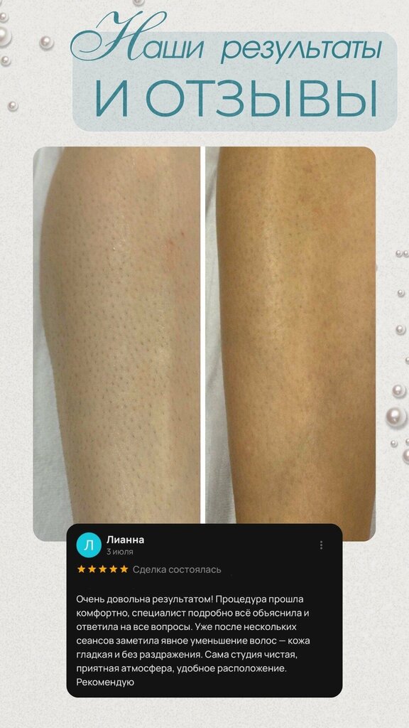 Epilasyon Protelo Laser, Moskova, foto