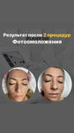 Laser Sollo (Vesennyaya ulitsa No:6), epilasyon  Liubertsy'den