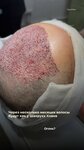 Hair transplantation OguzMed (Voroshilovskiy Avenue No:26), tıp merkezleri ve klinikler  Rostov‑na‑Donu'dan
