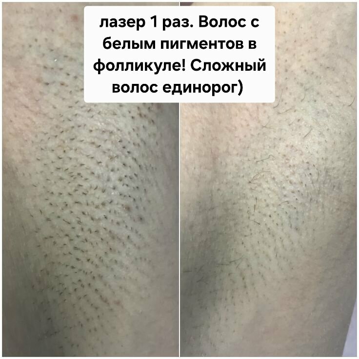 Epilasyon Elit Laser, Perm, foto