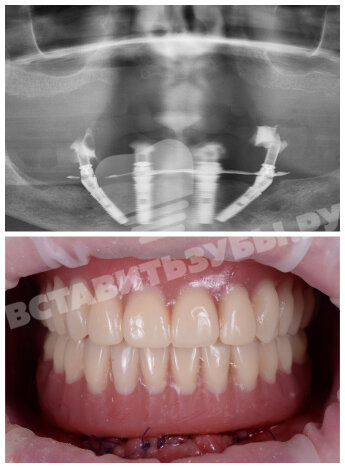 Özel ağız ve diş sağlığı klinikleri ve muayenehaneleri Зубы за 1 день, Moskova, foto