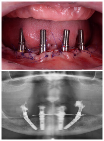 Özel ağız ve diş sağlığı klinikleri ve muayenehaneleri Зубы за 1 день, Moskova, foto