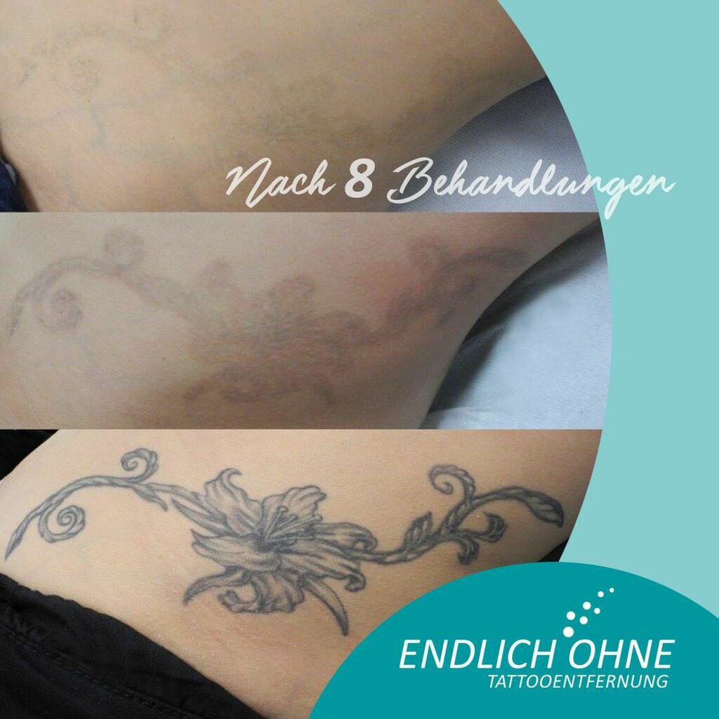 Özel muayenehaneler Endlich Ohne Tattooentfernung Permanent Make-up Entfernung Stuttgart, Stuttgart, foto
