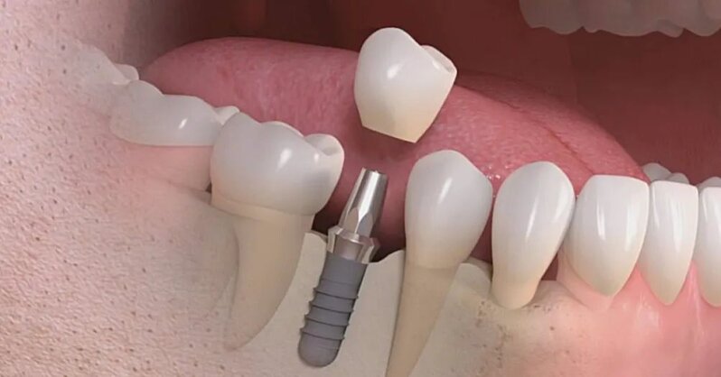 Özel ağız ve diş sağlığı klinikleri ve muayenehaneleri Cantarella Dr. ssa Vincenzina - Studio Dentistico, Sicilya, foto