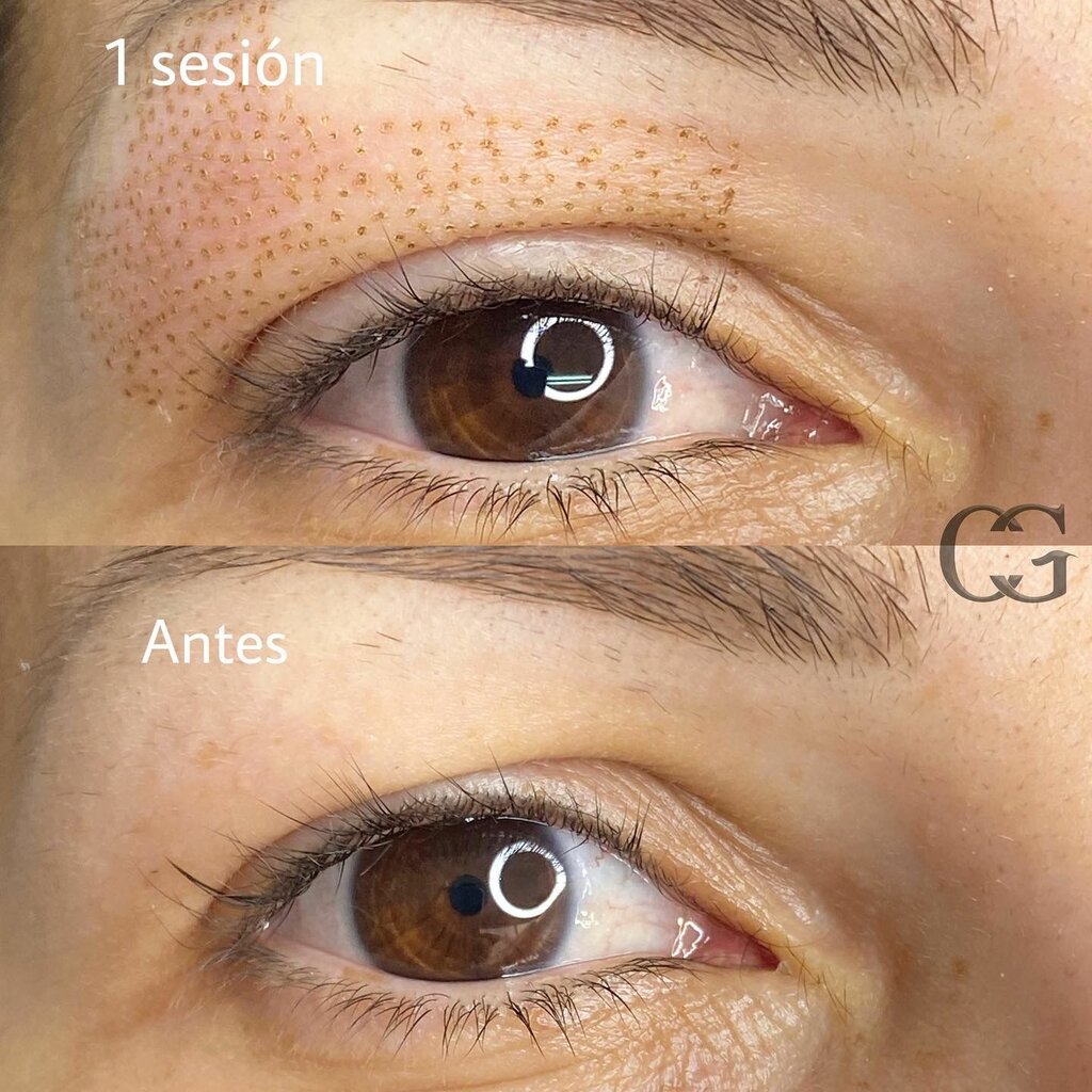 Plastik cerrahi klinikleri Micropigmentación Torrelavega - Microblading Cantabria - CG Brows & Beauty, Kantabria, foto