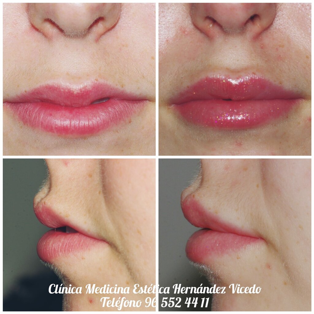Plastik cerrahi klinikleri Clínica De Medicina Estética Hernández Vicedo - Centro Médico Alcoi, Valensiya, foto