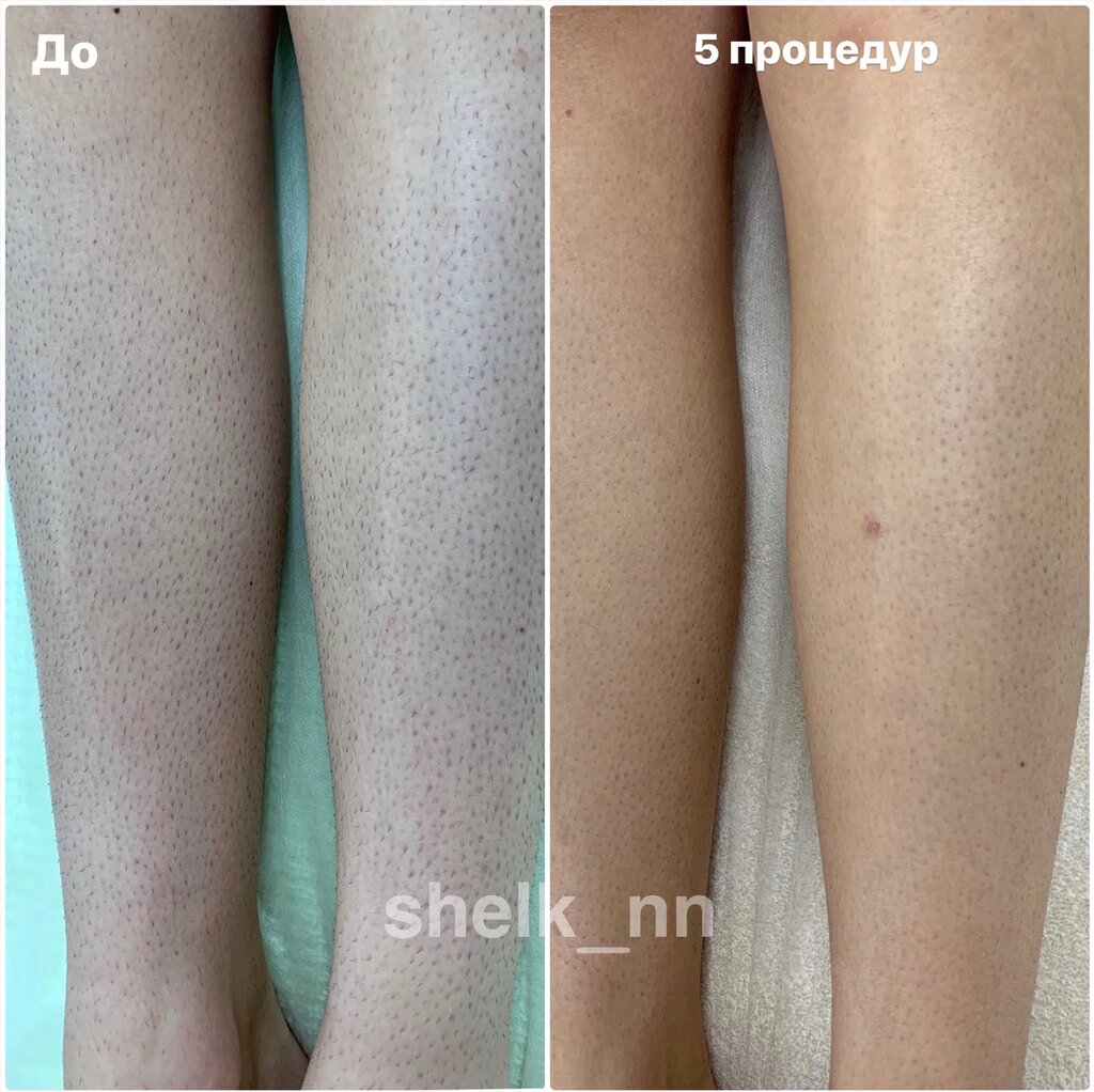 Epilasyon Shelk_nn, Nijni Novgorod, foto