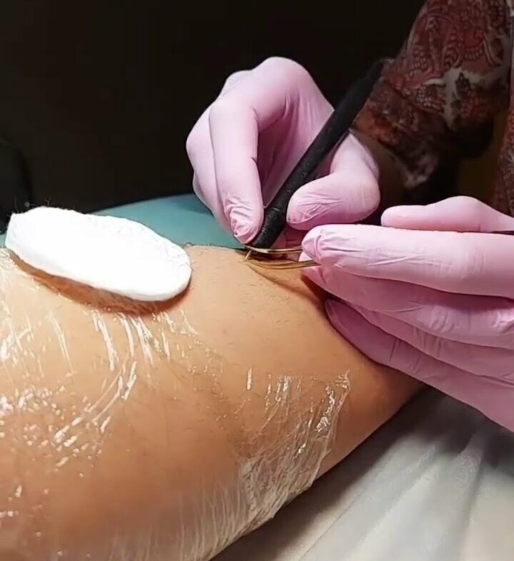 Epilasyon Electro-Epil, Krasnodar, foto