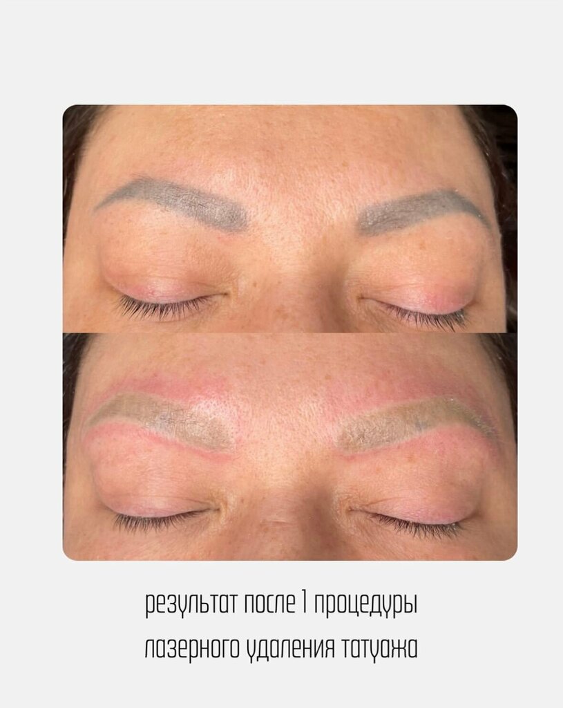 Dövmeciler Лазерное удаление тату, Achinsk, foto