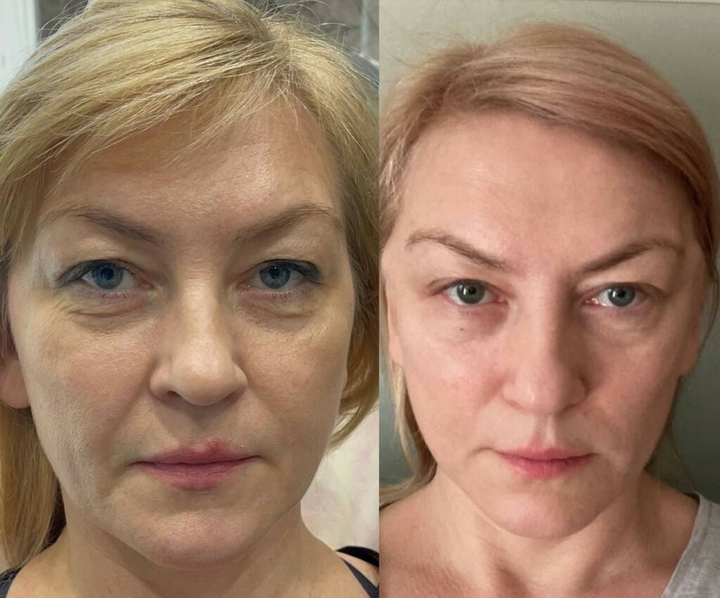 Kozmetoloji, kozmetik salonları ProBotoxx, Almatı, foto