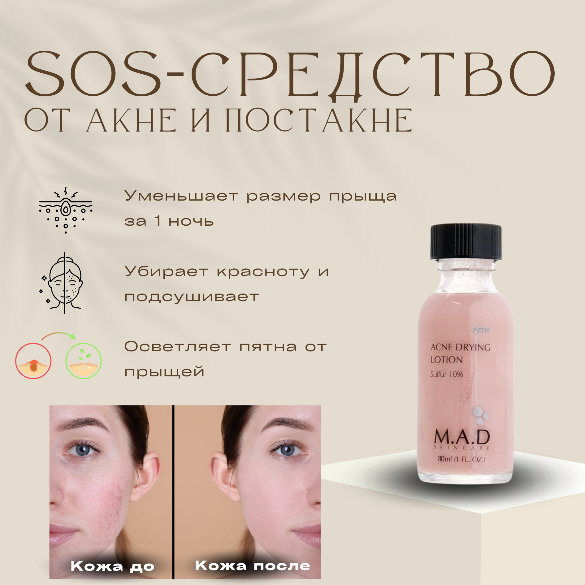 Болтушка sos — средство от прыщей, Acne Drying Lotion w Sulfur 10% — Подсушивающий лосьон с 10% серой, 30 мл.