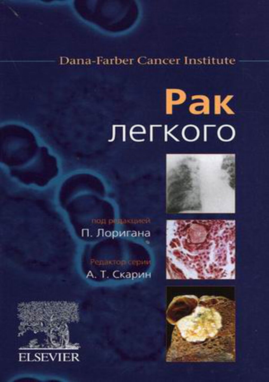 Рак легкого