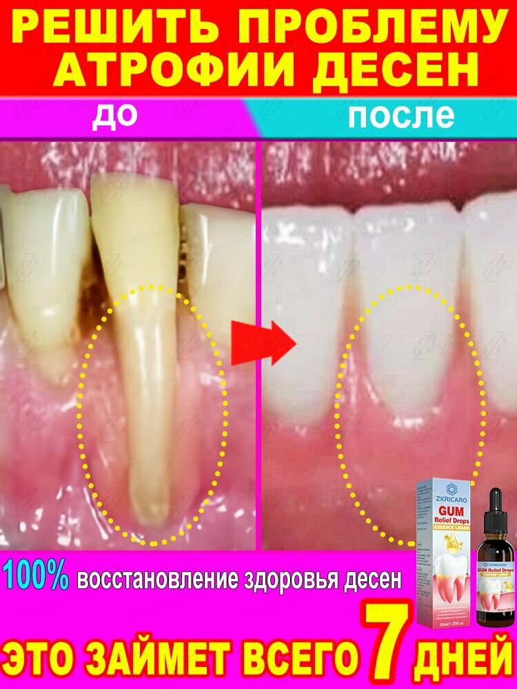 Используется для лечения пародонтита, стоматита, снятия чувствительности и отека десен, восстановления, профилактики и укрепления поврежденных десен, Гигиена полости рта.30 мл.