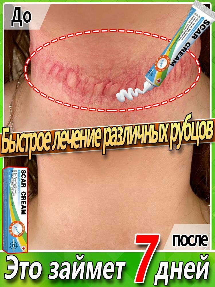 Этот крем от шрамов эффективно лечит различные виды рубцов, включая рубцы от угревой сыпи и растяжки, и предотвращает их повторное появление. Может использоваться на любой части тела. 20 грамм.