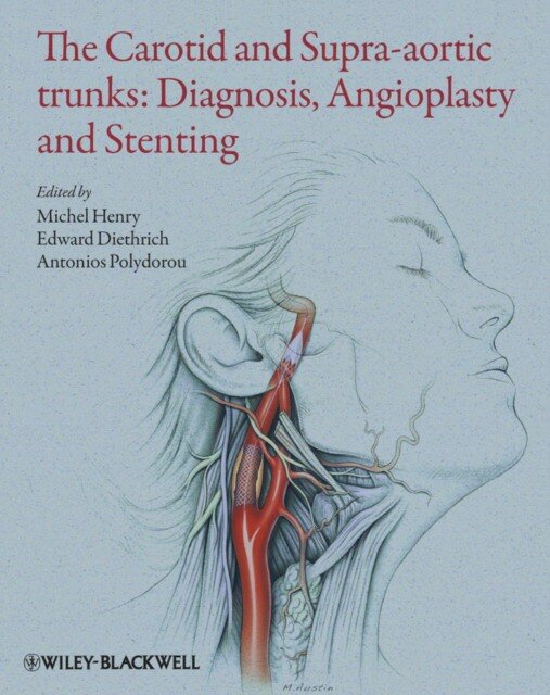 Michel Henry "The Carotid and Supra-Aortic Trunks: Diagnosis, Angioplasty and Stenting, 2E"