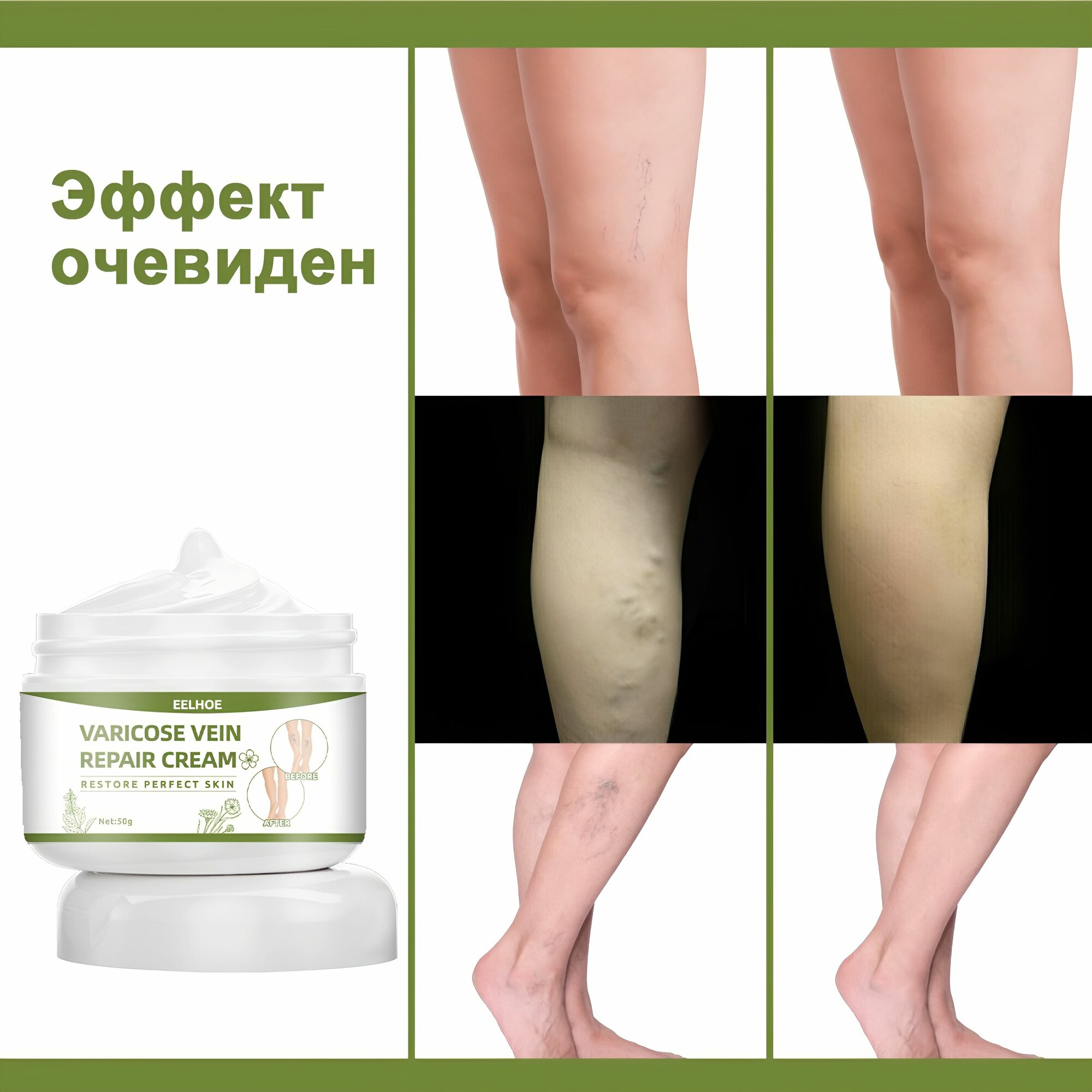 Крем для лечения варикозного расширения вен, Эффективен при лечении варикозного расширения вен, сосудистых звездочек, тромбоза, усталости и опухших ног / 50 г