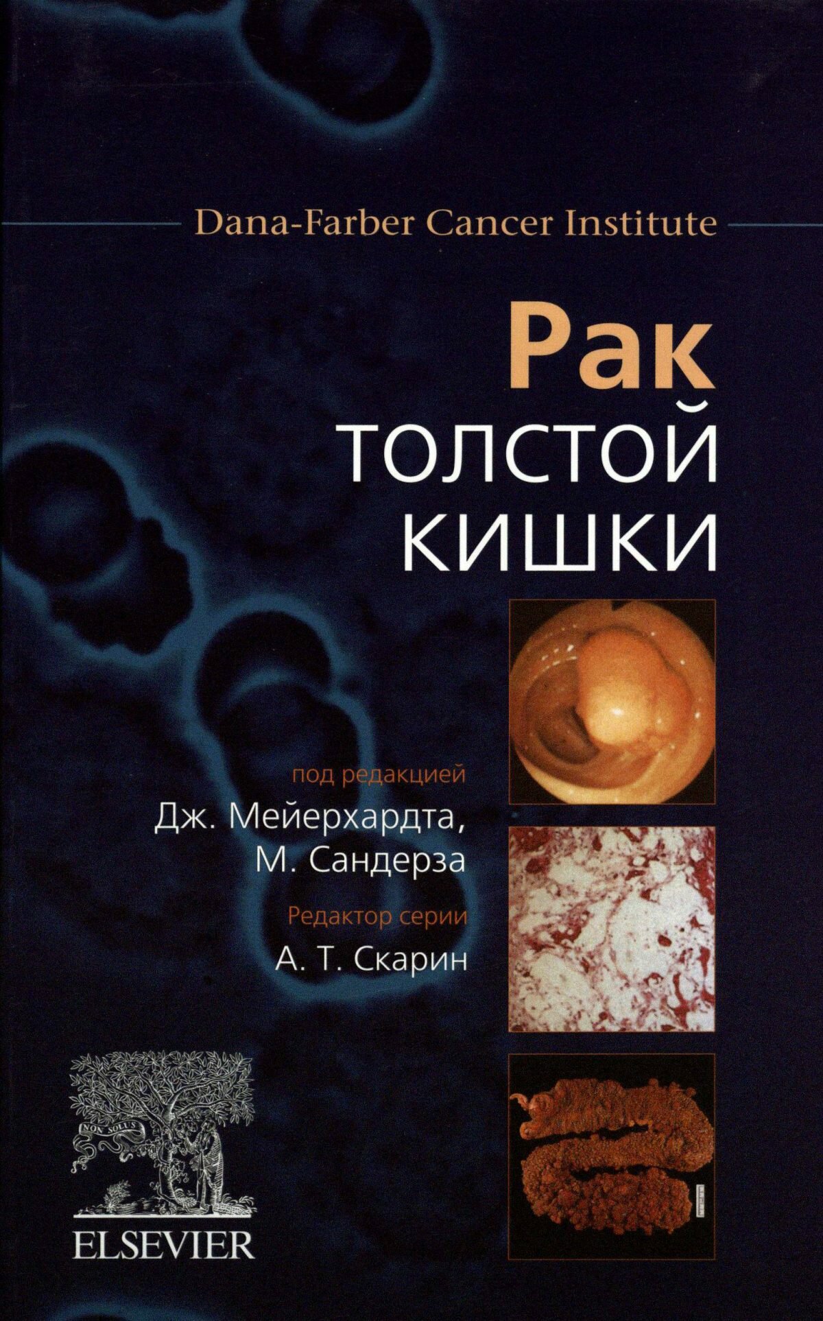 Рак толстой кишки