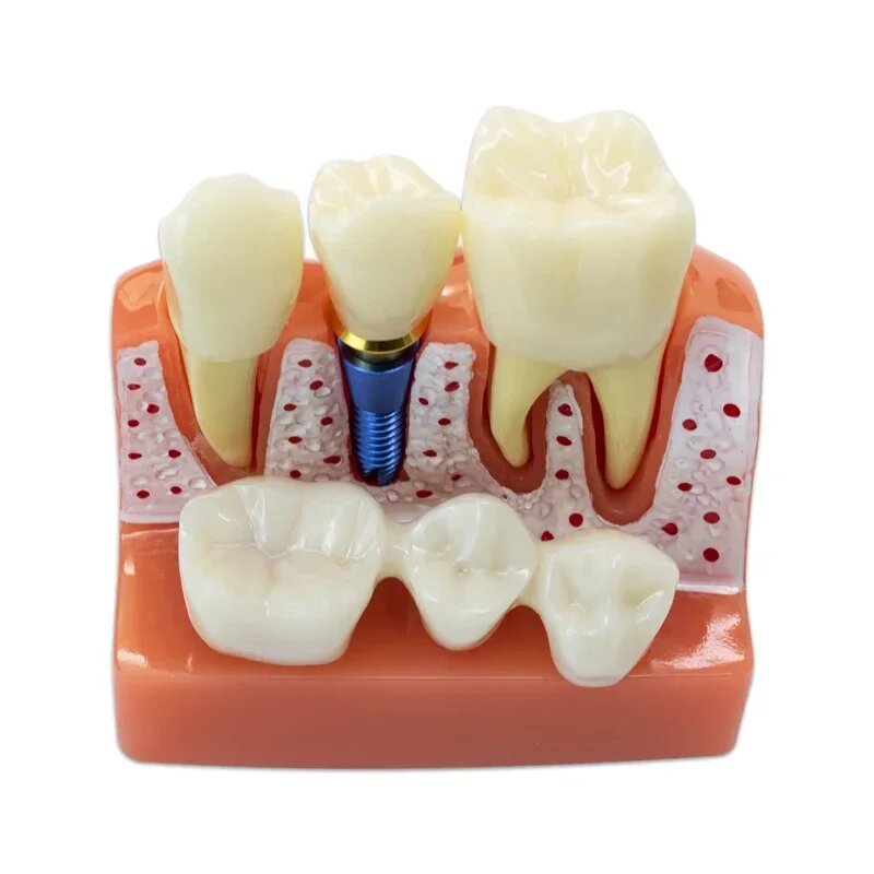 Съемная модель импланта SKATTOOTH Implante Dental Model 1