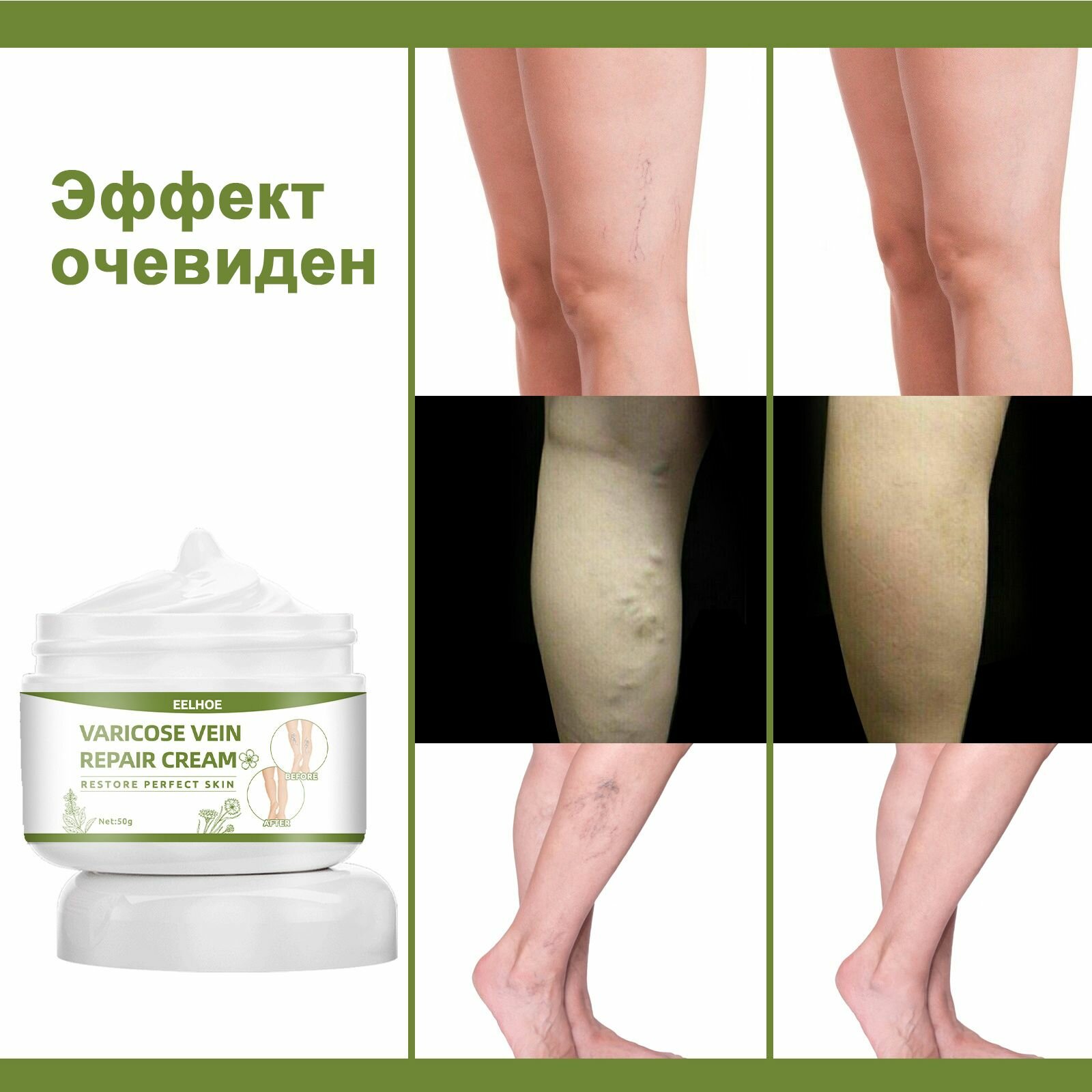 Крем для лечения варикозного расширения вен, Эффективен при лечении варикозного расширения вен, сосудистых звездочек, тромбоза, усталости и опухших ног / 50 г / 3 бутылки
