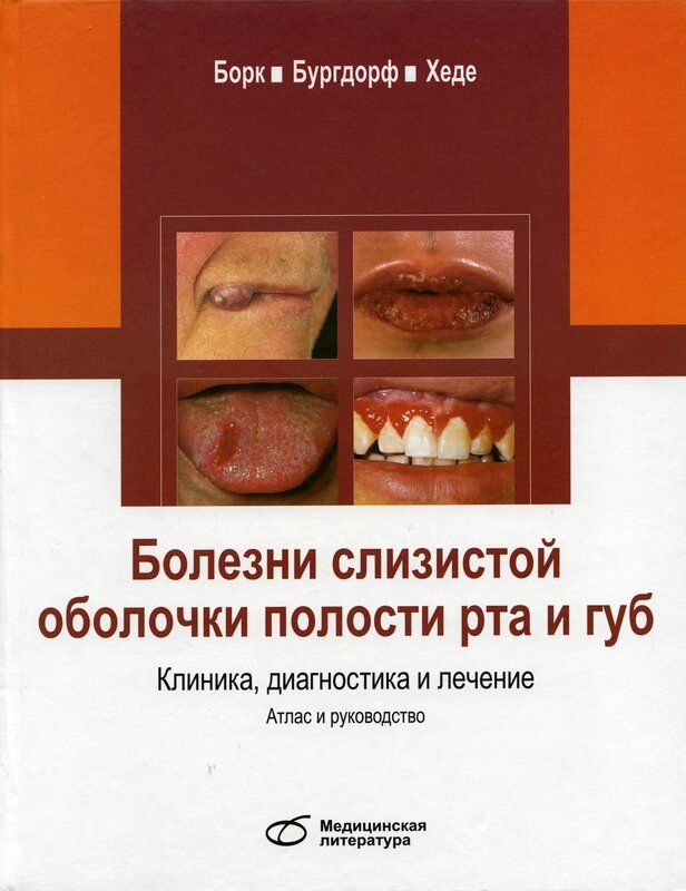 Болезни слизистой оболочки полости рта и губ. Клиника, диагностика и лечение. Атлас и р. (Бургдорф В, Борк К, Хеде Н.)