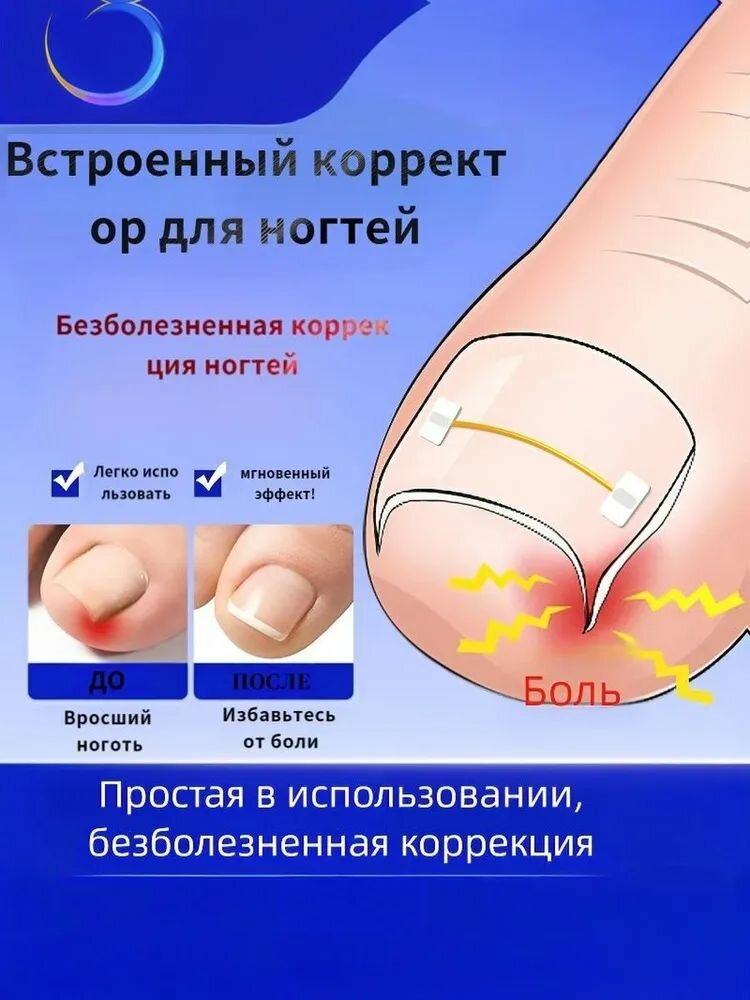 Комплект из 10 никелид-титановых корректоров для вросших ногтей