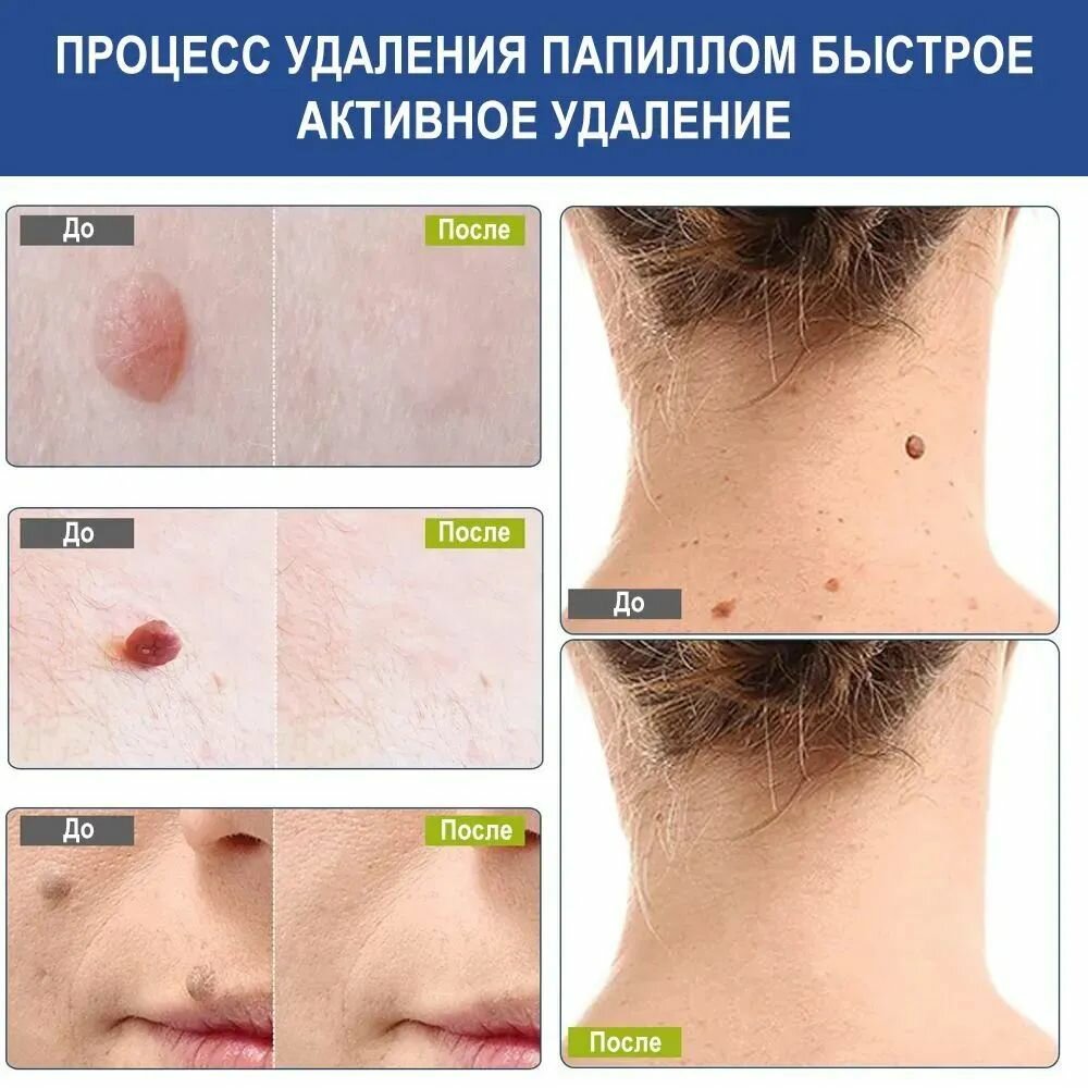 Папилофаг средство от папиллом и бородавок средство от папиллом и бородавок средство бородавок, кондилом, ороговевшей кожи 20 г