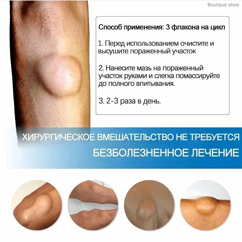 Мазь от липом и жировиков, быстро удаляет подкожные жировые опухоли, натуральный китайский, травяной крем для удаления целлюлита устранения, 30 г