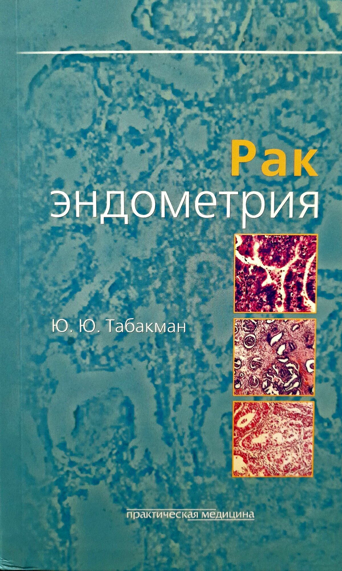 Рак эндометрия. Табакман