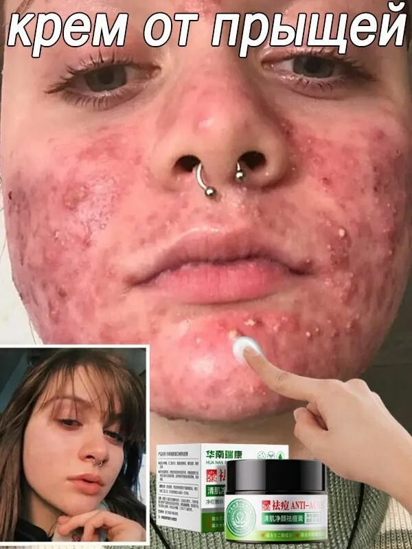 Средство от прыщей на лице, Удаление пылевых клещей, Крем от прыщей, угрей, черных точек, акне и постакне для подростков 50 мл