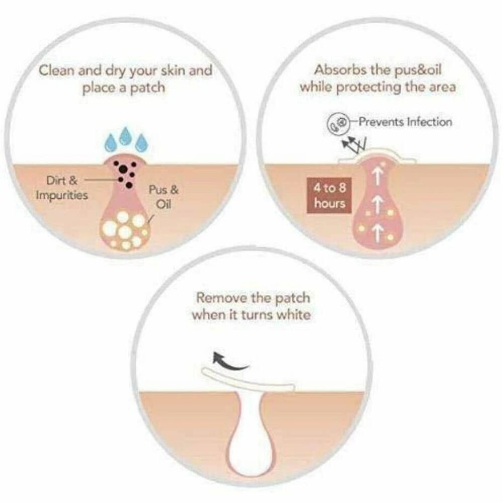 Женский антиинфекционный быстро впитывающийся уход за лицом гидрогелевый пластырь для удаления родинок на коже от угревой сыпи пластырь от прыщей