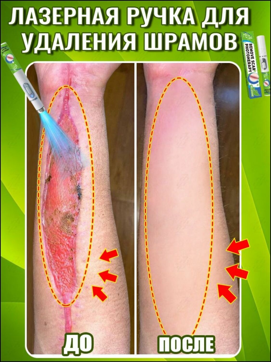 Лазерная ручка для удаления шрамов, используемая для удаления шрамов, растяжек, травм и пигментации, устранения рубцов, восстановления гладкости кожи и быстрого заживления. одна лазерная ручка