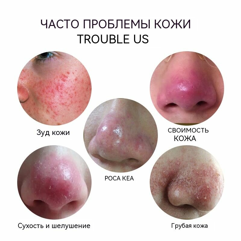 Крем от купероза и розацеа от покраснений и раздражений на коже,50 г, Тайский формула